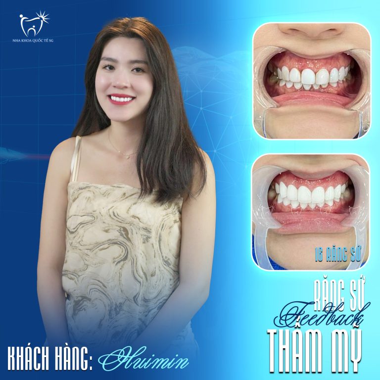 Dán Sứ Veneer Là Gì? Quy Trình Dán Sứ Veneer Tại Nha Khoa Quốc Tế SG