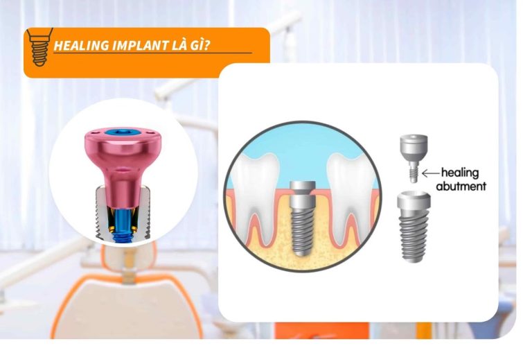 Healing trong implant là gì? Phân loại chi tiết các dòng