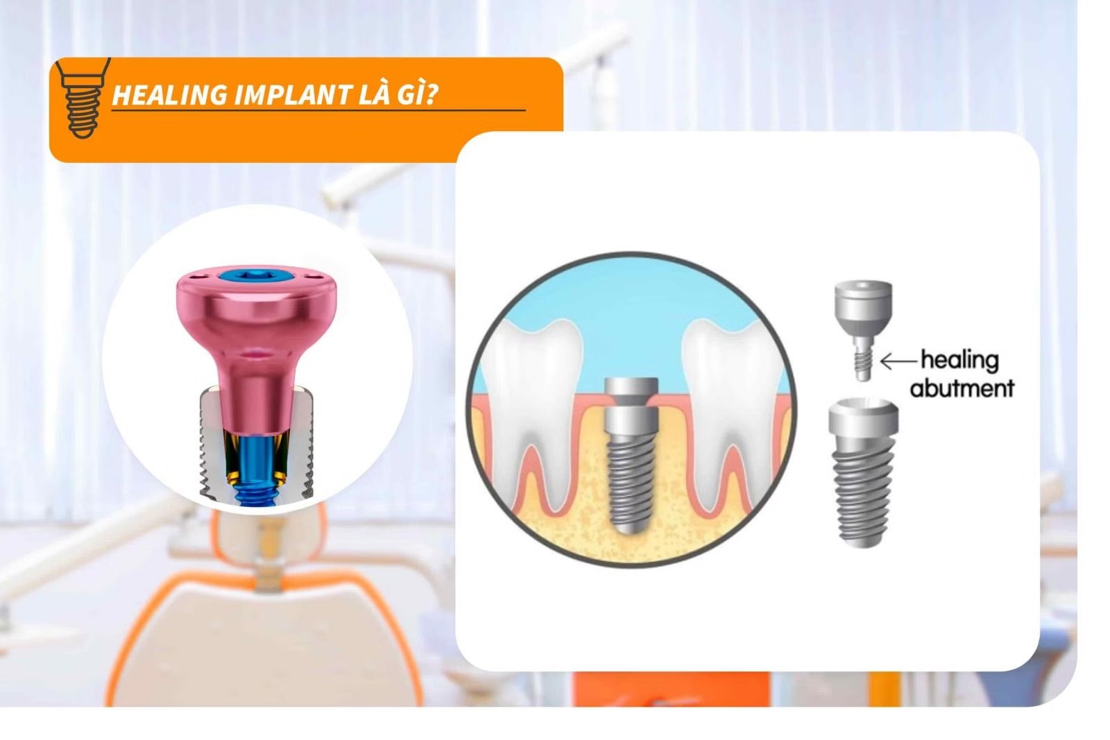 Healing trong implant là gì? Phân loại chi tiết các dòng