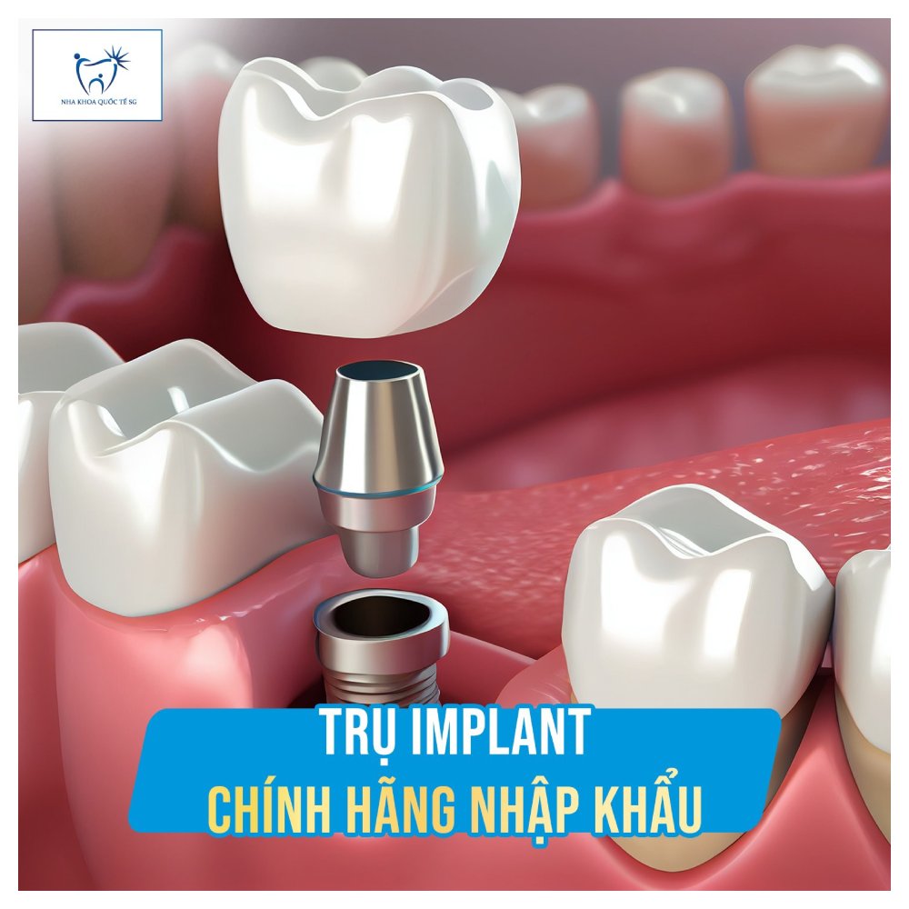 Trụ implant nào tốt? So sánh các loại Implant [05/2026]